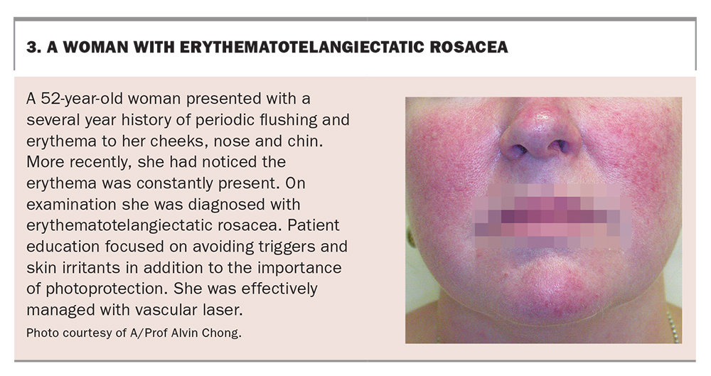 Rosacea: a thorny problem with a rosy outlook | Medicine Today